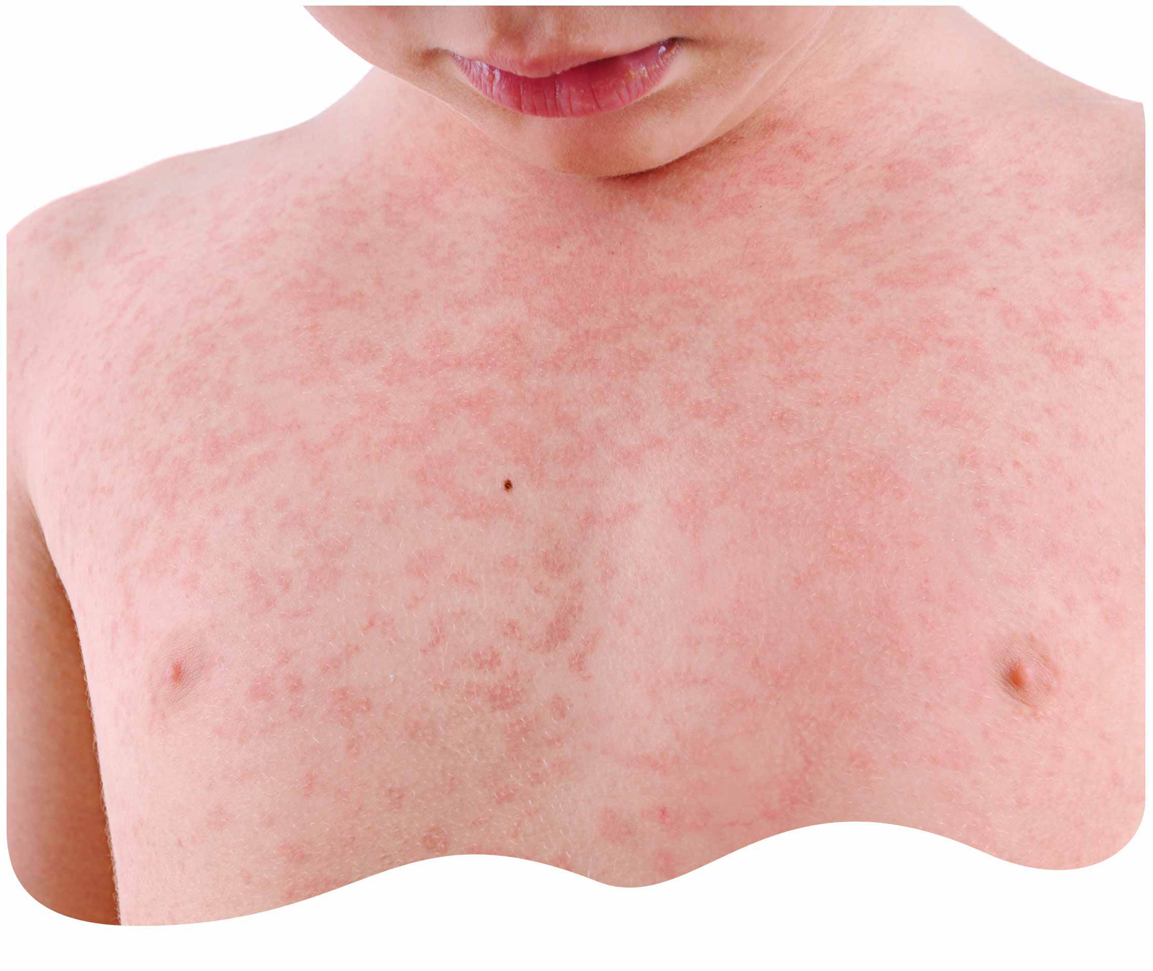 CAPS - Cryopyrin-assoziierte periodische Syndrome