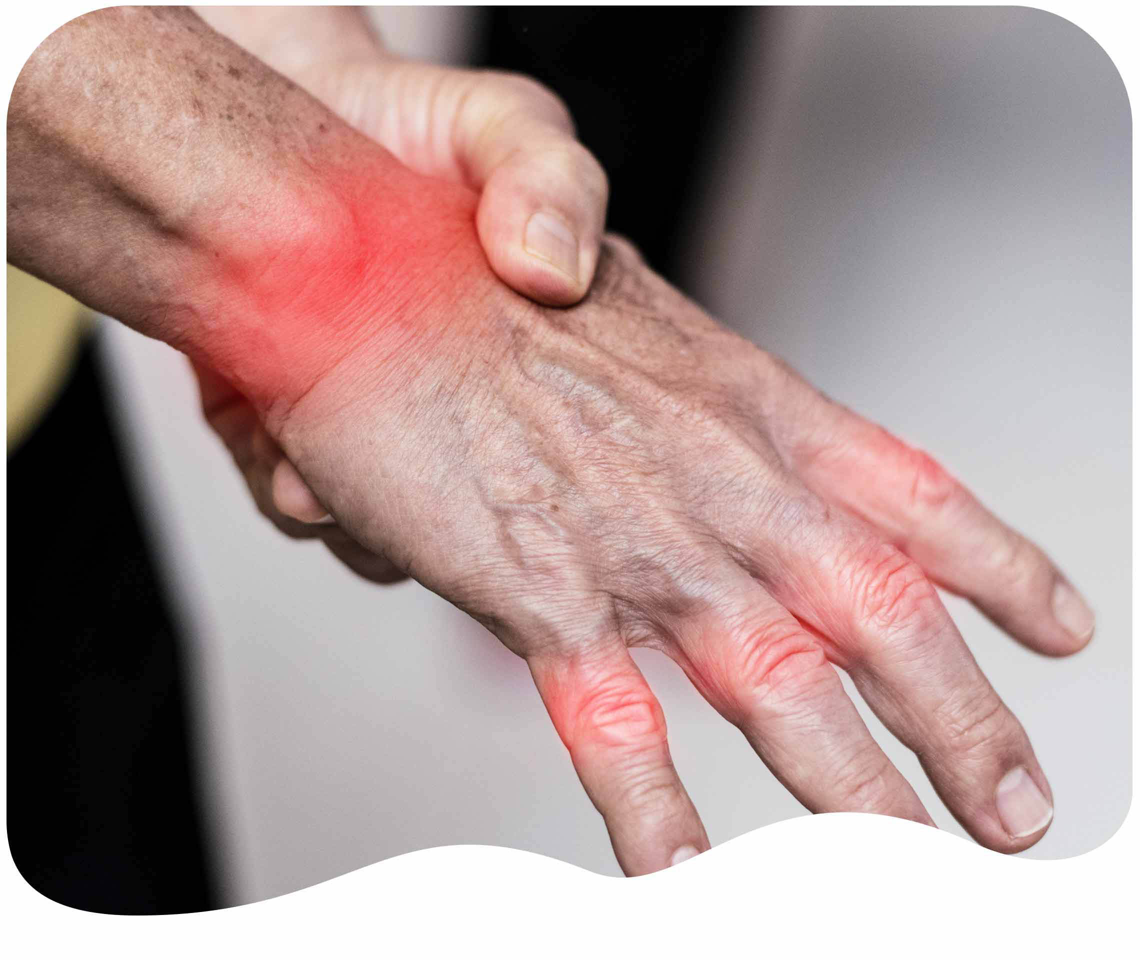 Gicht - eine autoinflammatorische Erkrankung